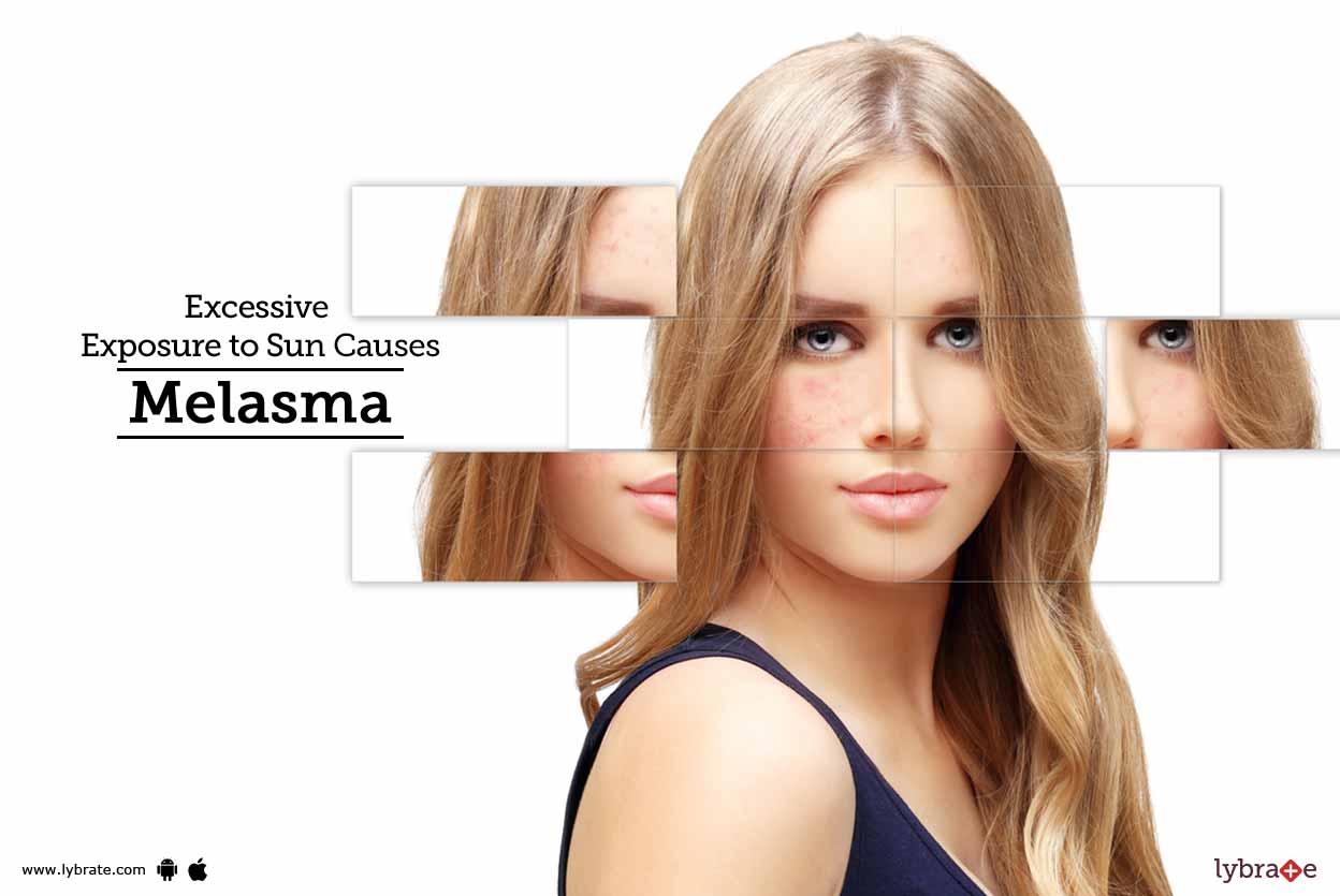 Excessive Exposure to Sun Causes Melasma - By Dr. Shweta Kesarwani ...