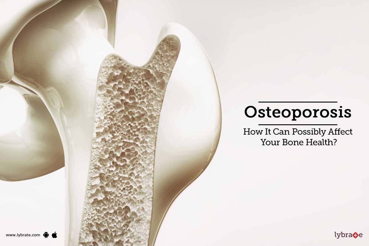 Osteoporosis - How It Can Possibly Affect Your Bone Health? - By Dr ...