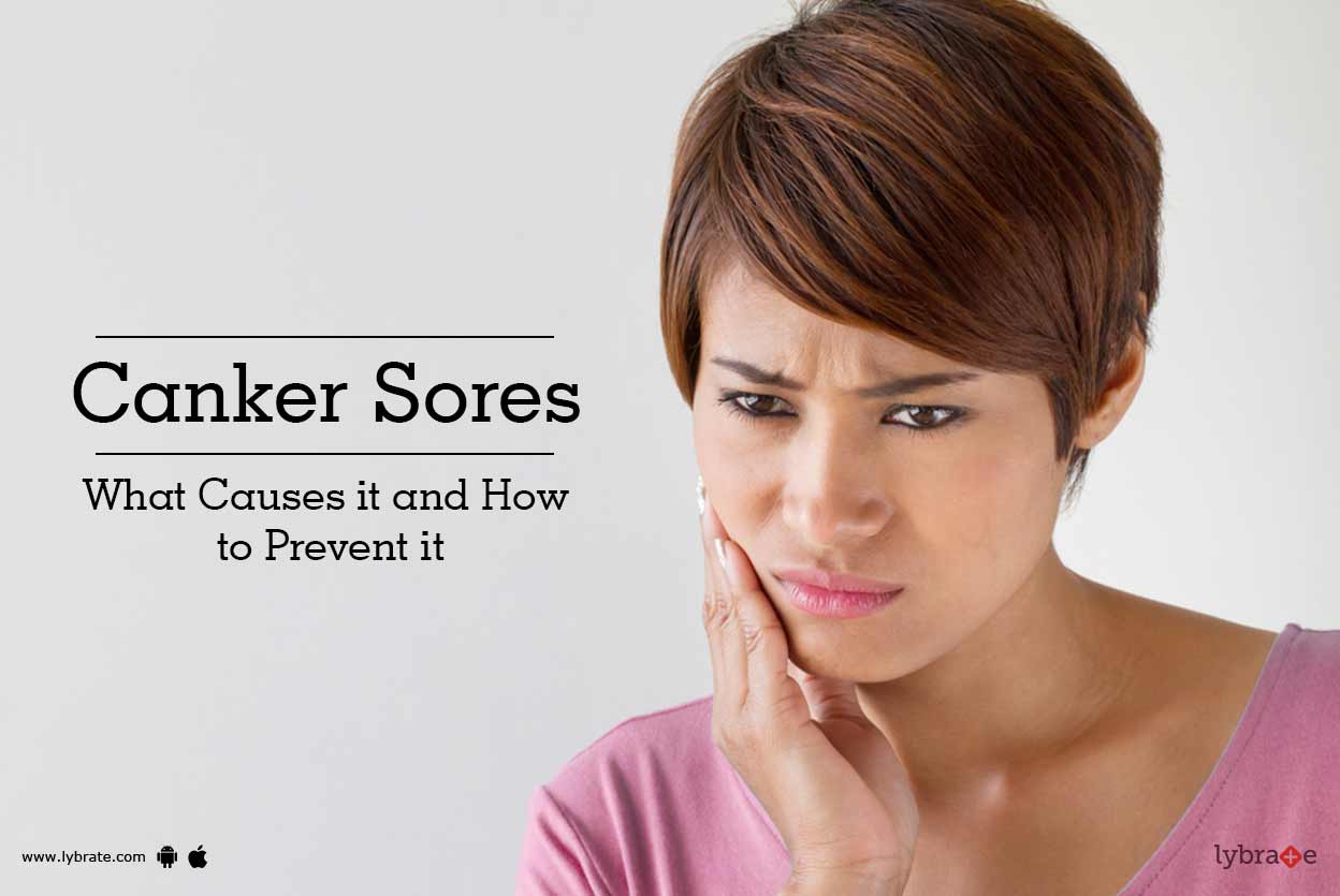 Canker Sores - What Causes it and How to Prevent it - By Dr. Sahil ...
