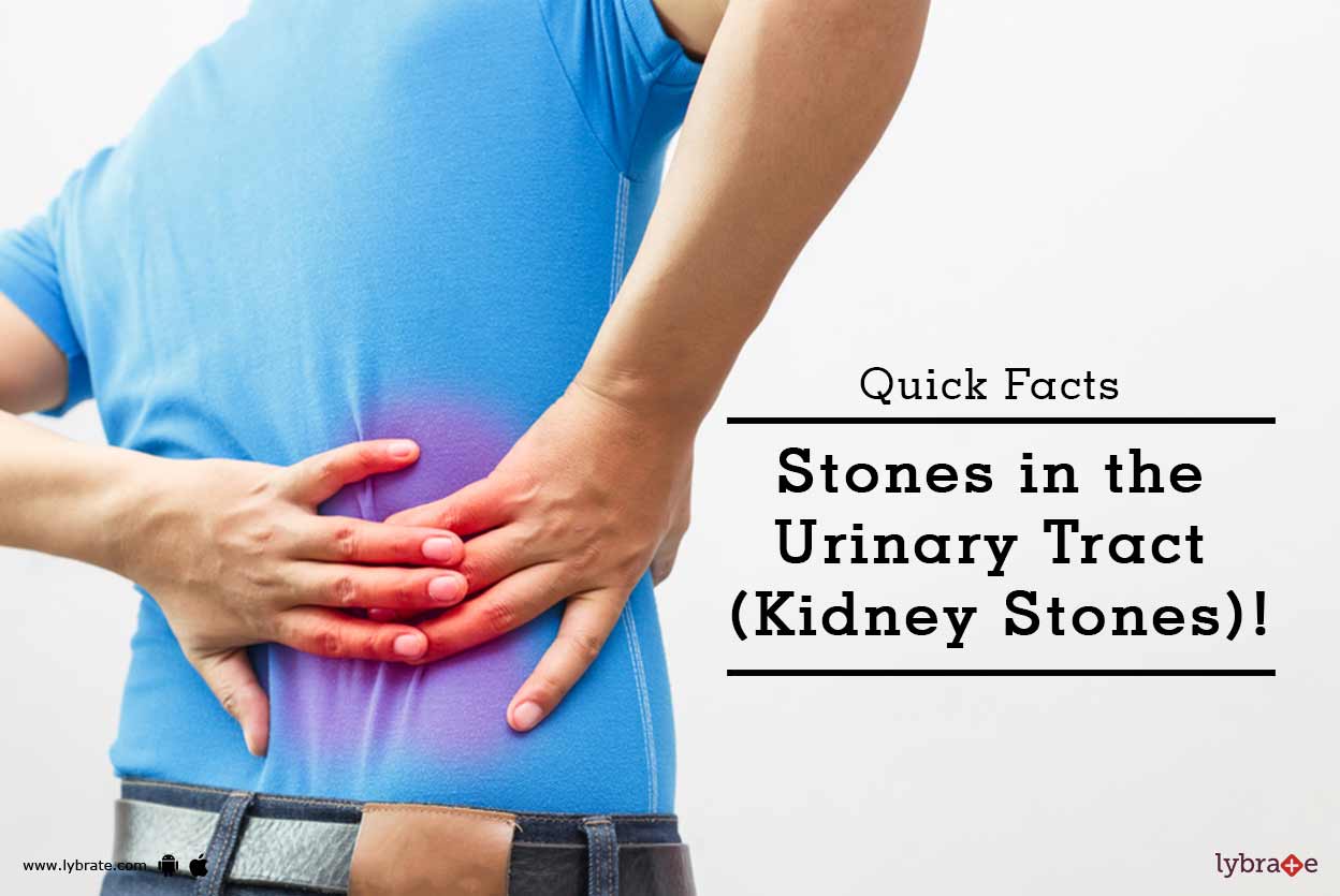 Quick Facts: Stones in the Urinary Tract (Kidney Stones)! - By Dr ...