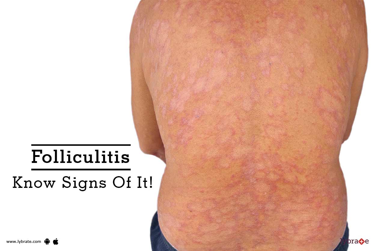 Folliculitis - Know Signs Of It! - By Dr. Deepti Shrivastava | Lybrate