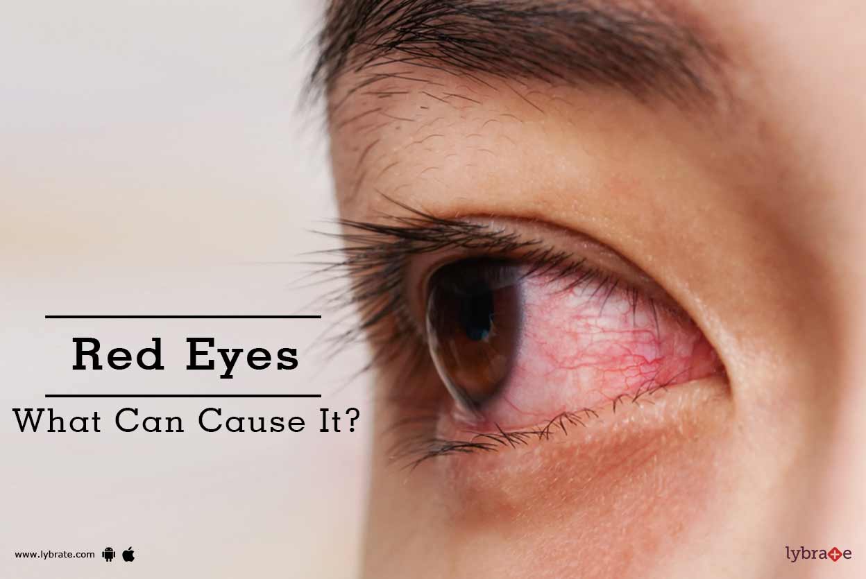 Red Eyes - What Can Cause It? - By Dr. Surendra Prakash | Lybrate