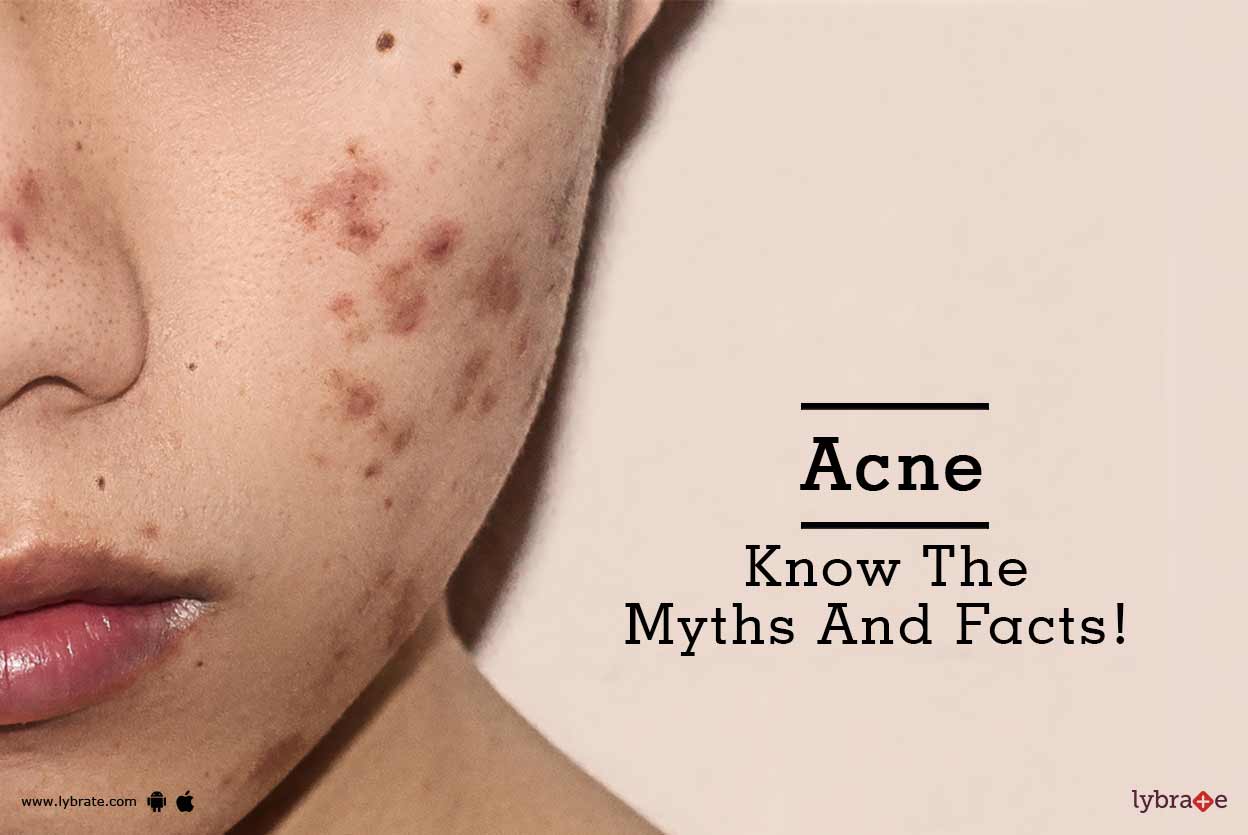 Acne - Know The Myths And Facts! - By Dr. Sheelavathi Natraj | Lybrate