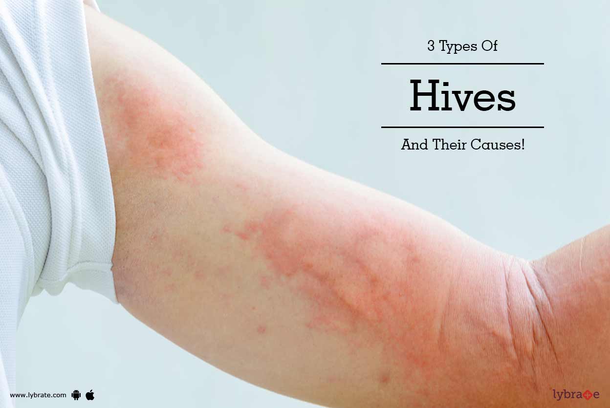3 Types Of Hives And Their Causes! - By Dr. Manju Keshari | Lybrate