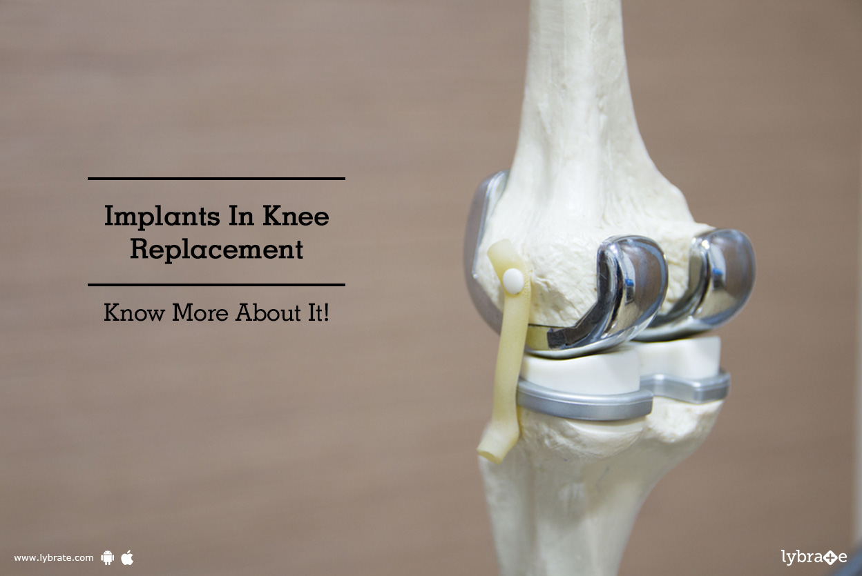 Implants In Knee Replacement - Know More About It! - By Dr. Sunil Kumar ...