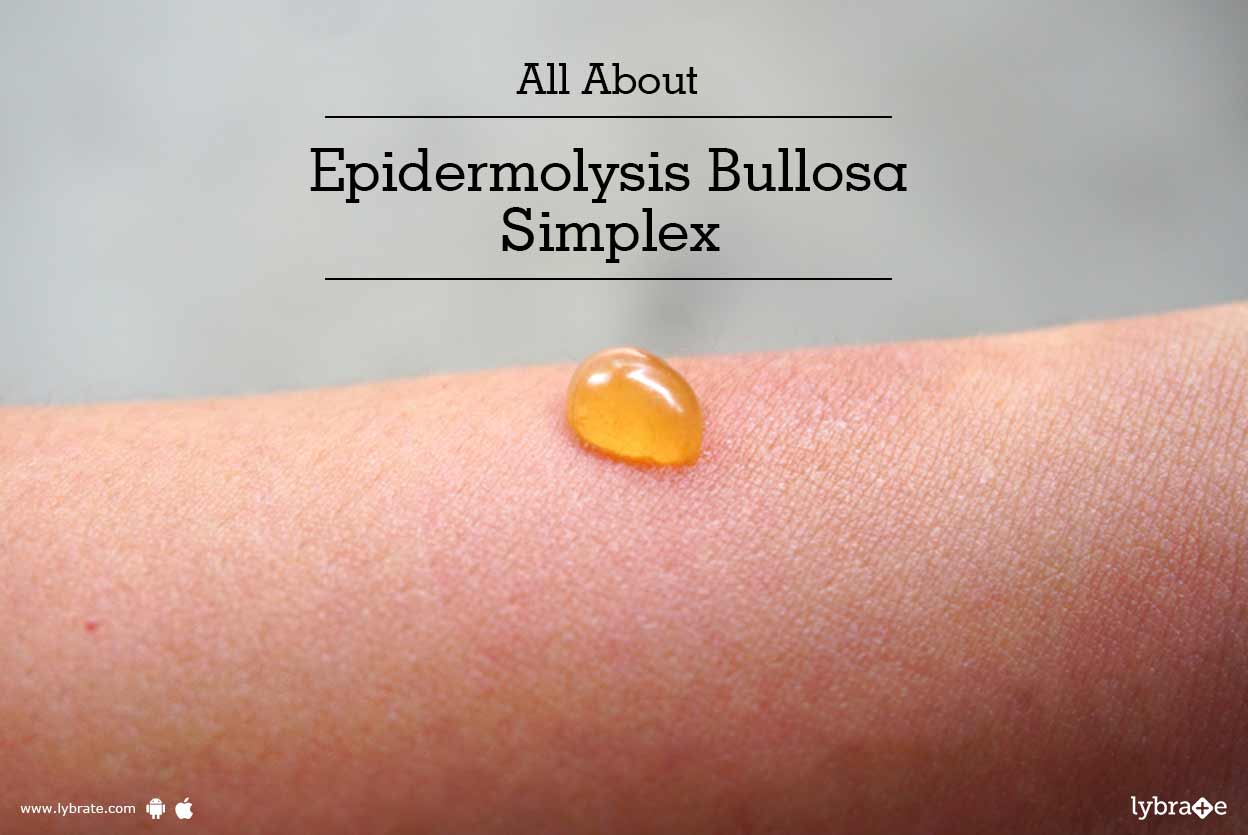 Epidermolysis Bullosa Simplex Wikipedia
