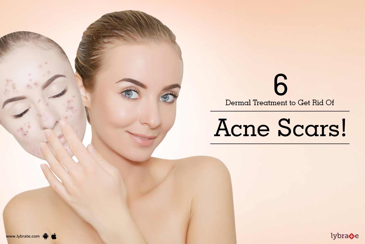 6 Dermal Treatment to Get Rid Of Acne Scars! - By Dr. Navneet Bansal ...