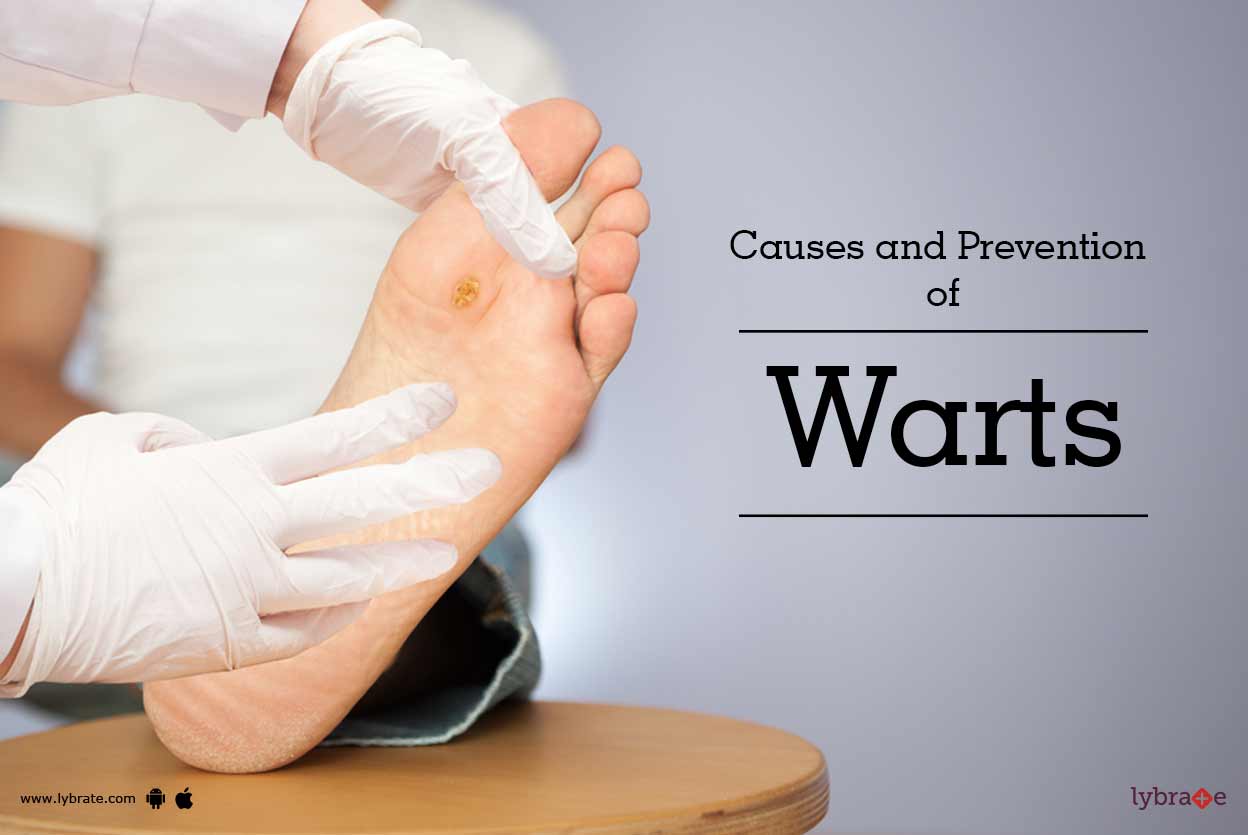 Causes and Prevention of Warts - By Dr. V.Sethu Raman | Lybrate