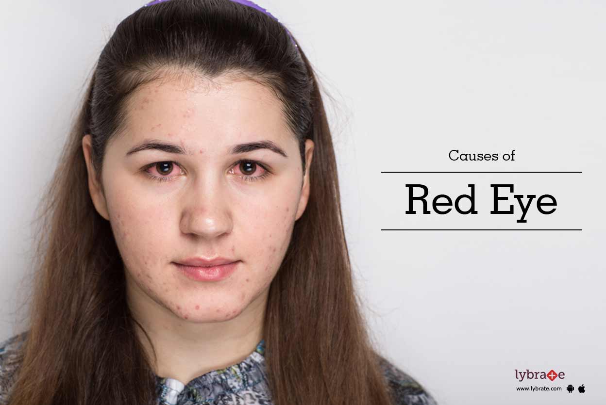 Causes of Red Eye - By Dr. Prof M R Jain | Lybrate