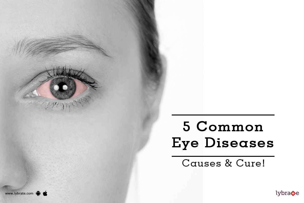 5 Common Eye Diseases - Causes & Cure! - By Dr. Ruchi | Lybrate