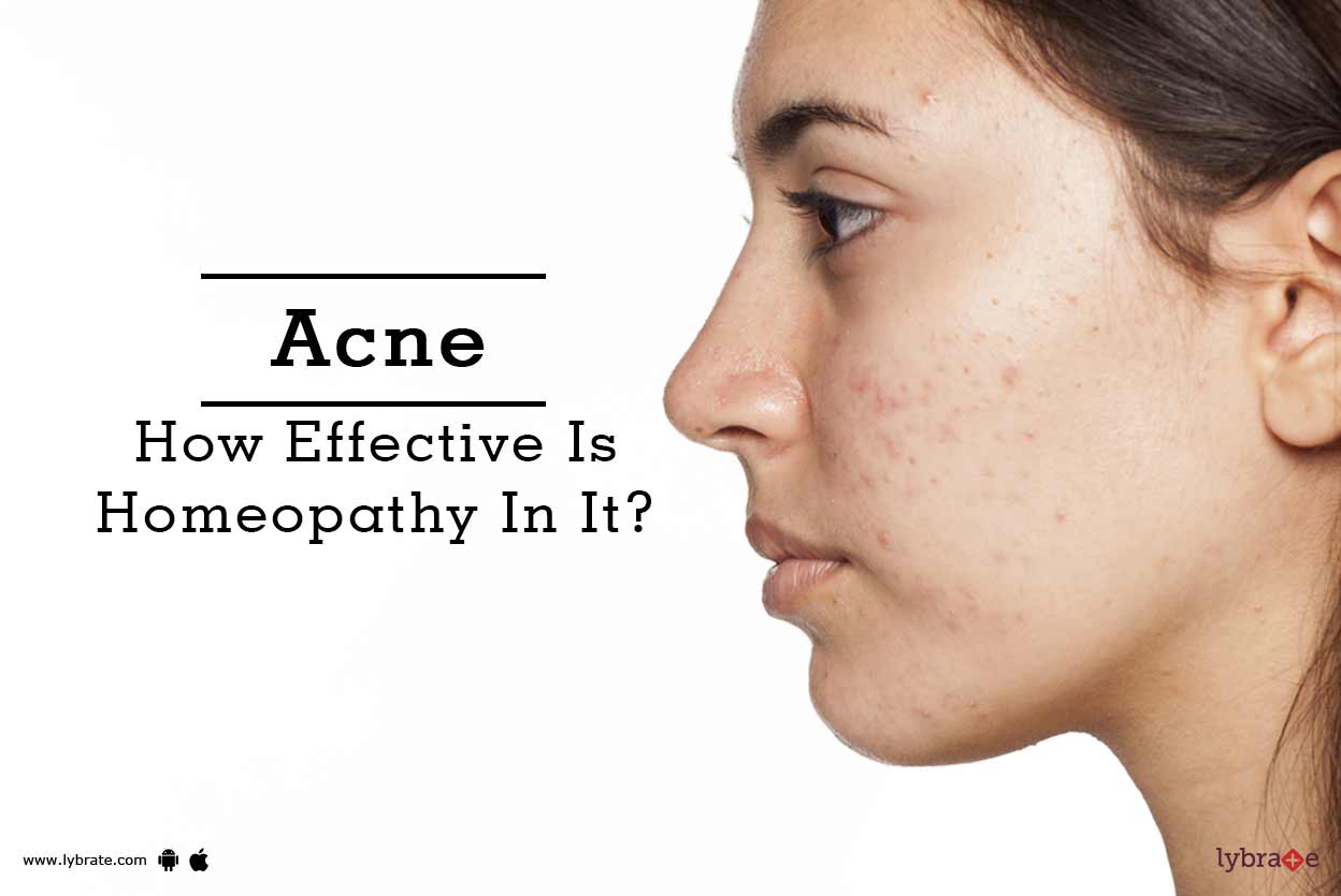 Acne - How Effective Is Homeopathy In It? - By Dr. Abhishek Pathak ...