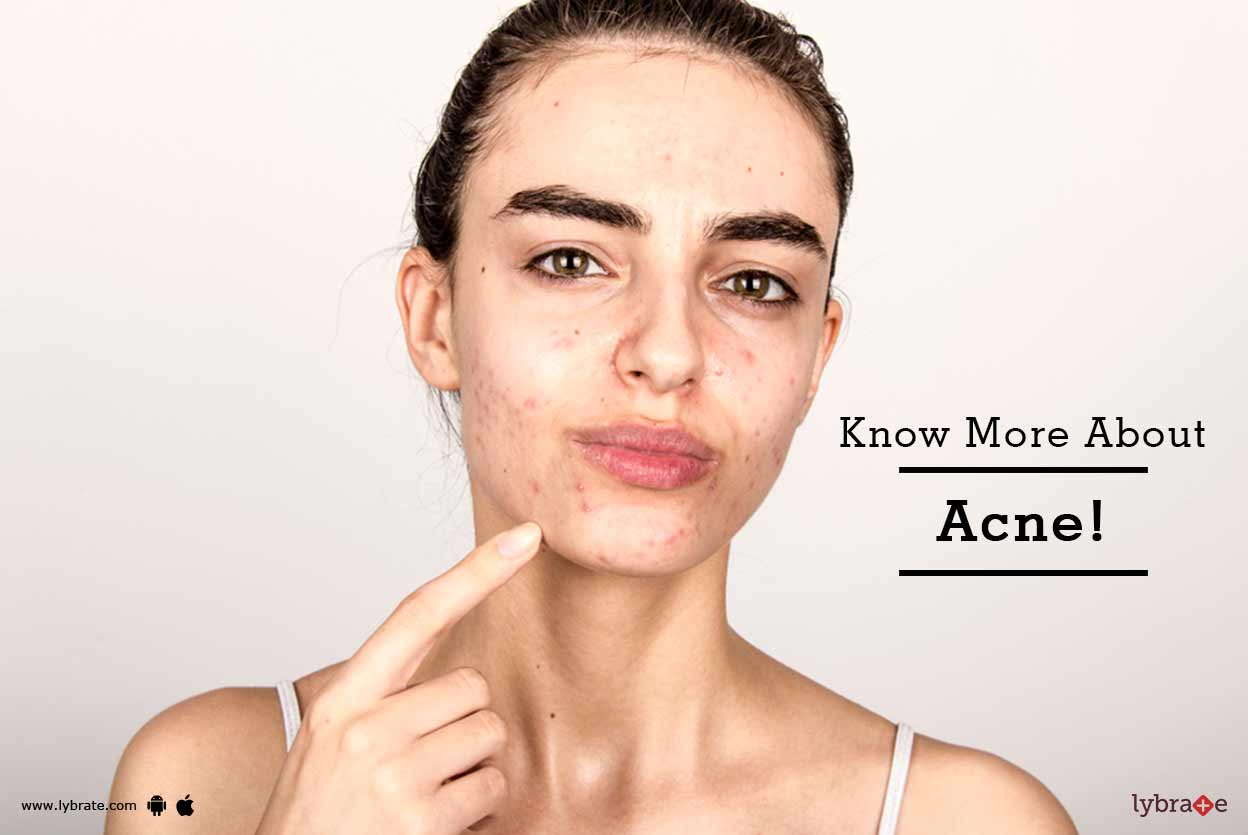 Know More About Acne! - By Dr. Vanishree S.V | Lybrate