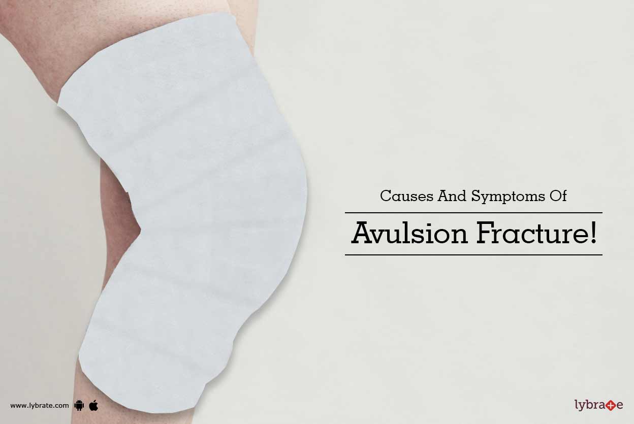 Causes And Symptoms Of Avulsion Fracture! - By Dr. Vivek A N | Lybrate