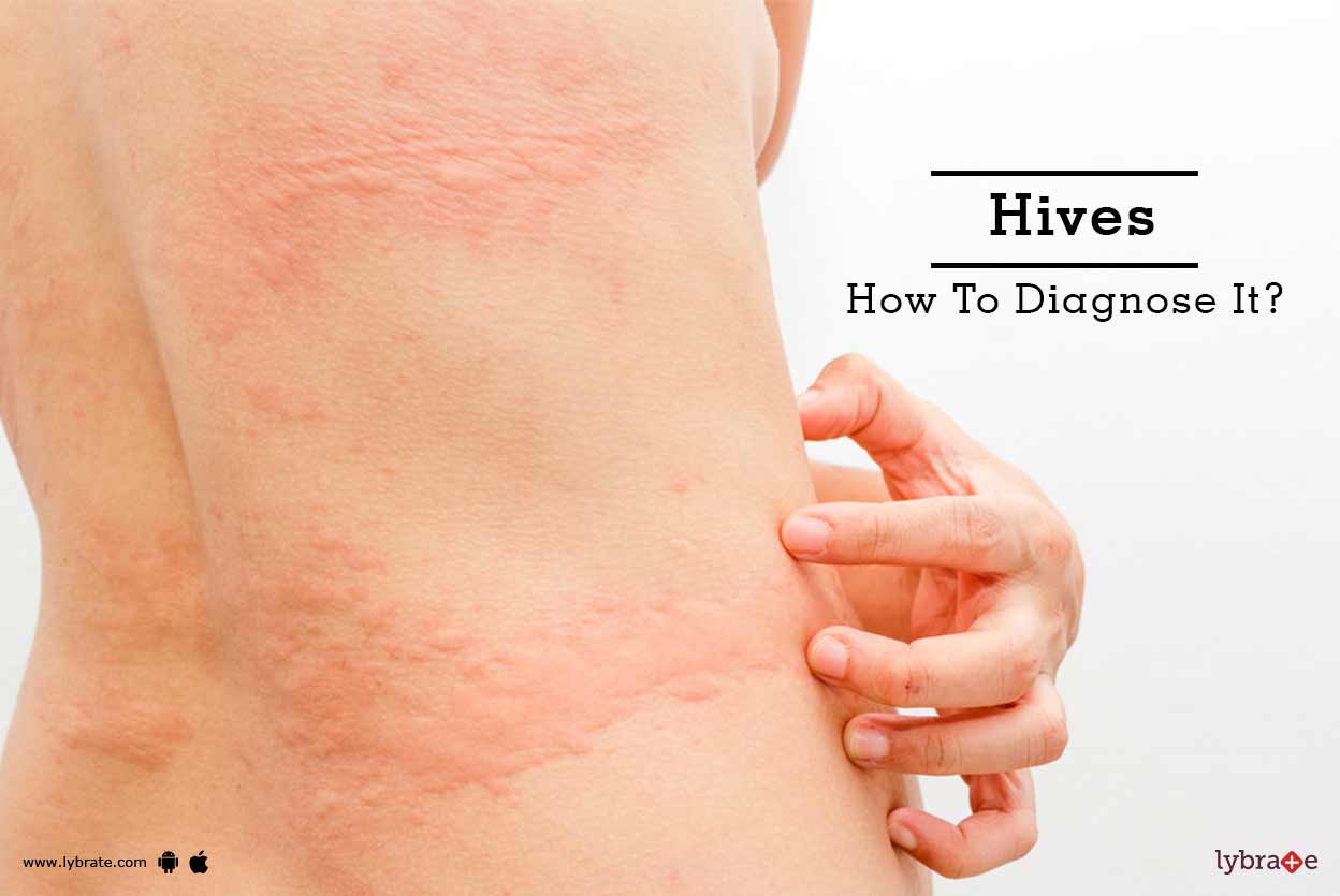 Hives - How To Diagnose It? - By Dr. Mohan Darbastwar | Lybrate