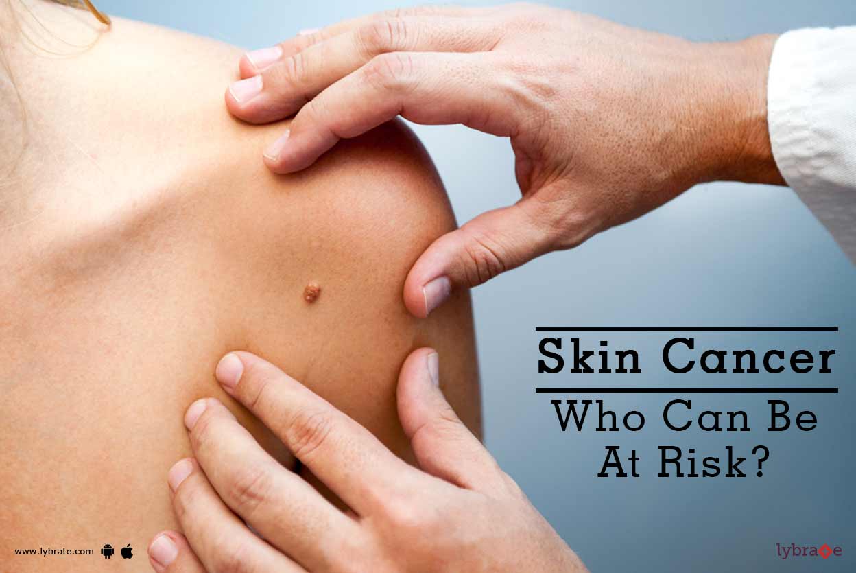 Skin Cancer - Who Can Be At Risk? - By Dr. Deepti Shrivastava | Lybrate