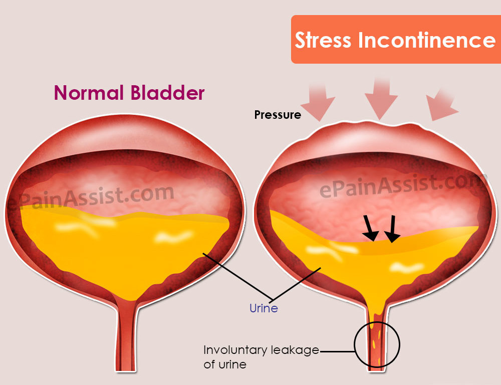 Involuntary Urination - What Causes It? - By Dr. Radhika Amulraj | Lybrate
