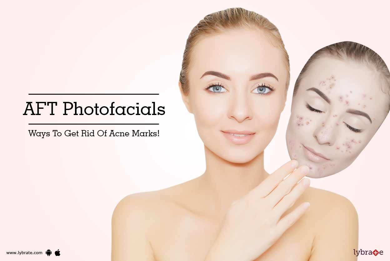 AFT Photofacials: Ways To Get Rid Of Acne Marks! - By Kaya Skin Clinic ...