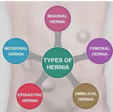 Types Of Hernia - By Dr. Sapan | Lybrate