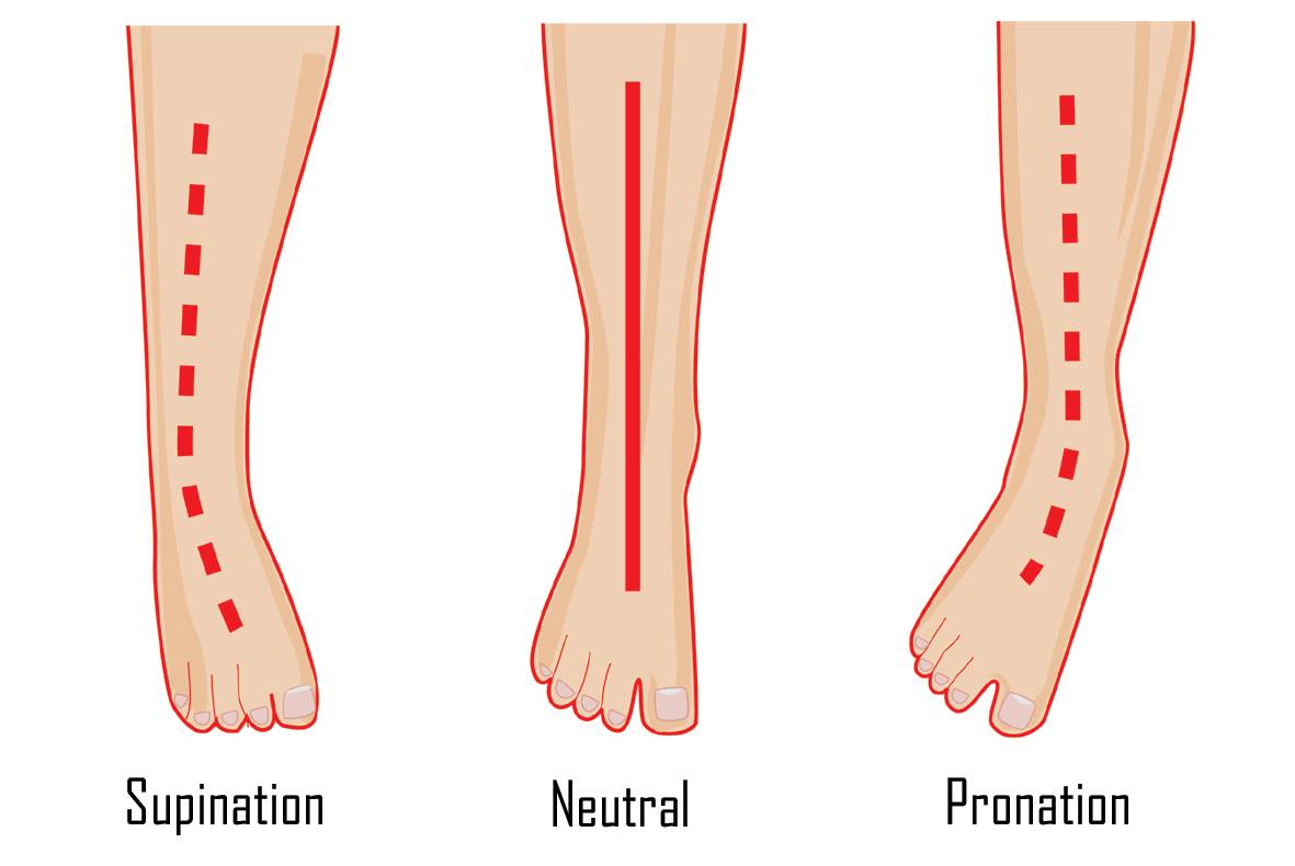 Here is a quick guide on various foot malalignments - By Dr. Pallavi ...