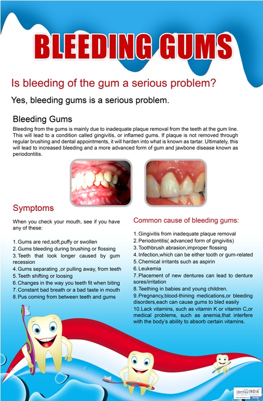 Bleeding Gums ! - By Dr. Kiran Kumar | Lybrate