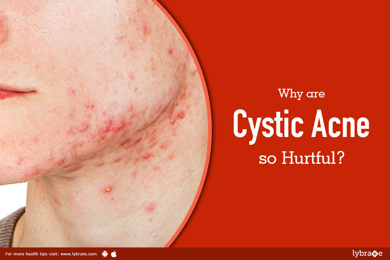 Why are Cystic Acne so Hurtful? - By Dr. Akhilendra Singh | Lybrate