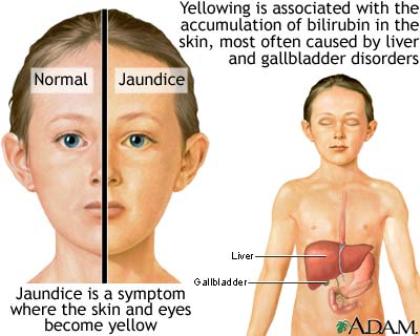 What Is Gilbert s syndrome? - By Dr. Radhika Amulraj | Lybrate