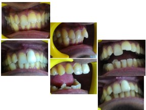 Cosmetic Alignment of Teeth- Fast, easy and painless - By Dr. Prashant ...