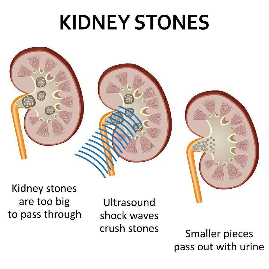 How Is Kidney Stone Treated? - By Dr. Satyajeet P Pattnaik | Lybrate