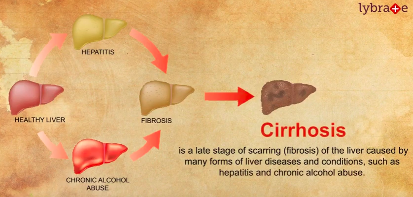 Liver Cirrhosis - How Can Ayurveda Help? - By Dr. Paresh J Thakkar ...