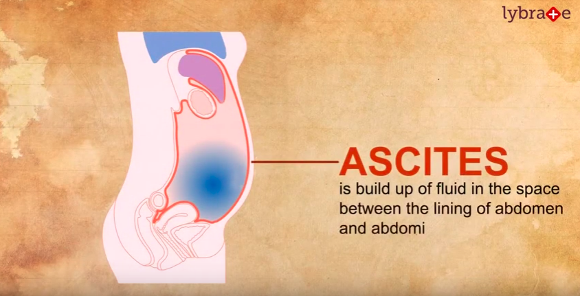 Ascites - What Is IT? - By Dr. Paresh J Thakkar | Lybrate