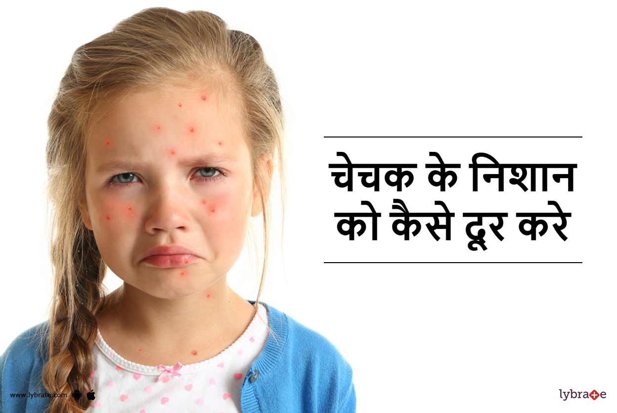 How to Remove Chickenpox Marks? - चेचक के निशान को कैसे दूर करे - By Dt ...
