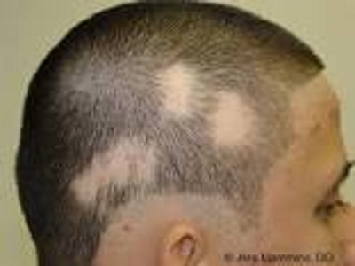 Patchy Hair Loss - By Dr. Amey Kelkar | Lybrate