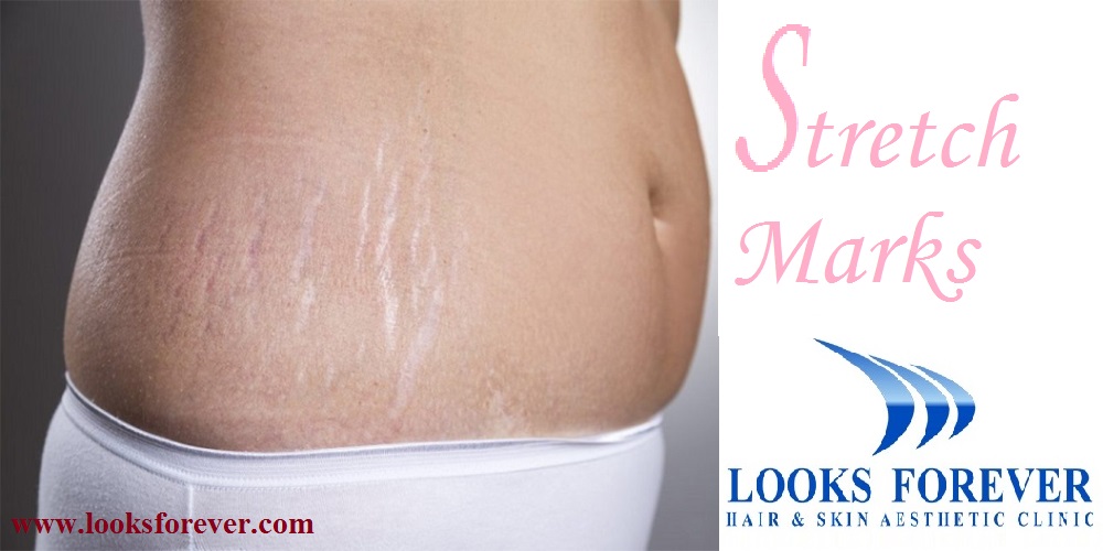 What are Stretch Marks? - By Looks Forever Hair And Skin Aesthetic ...