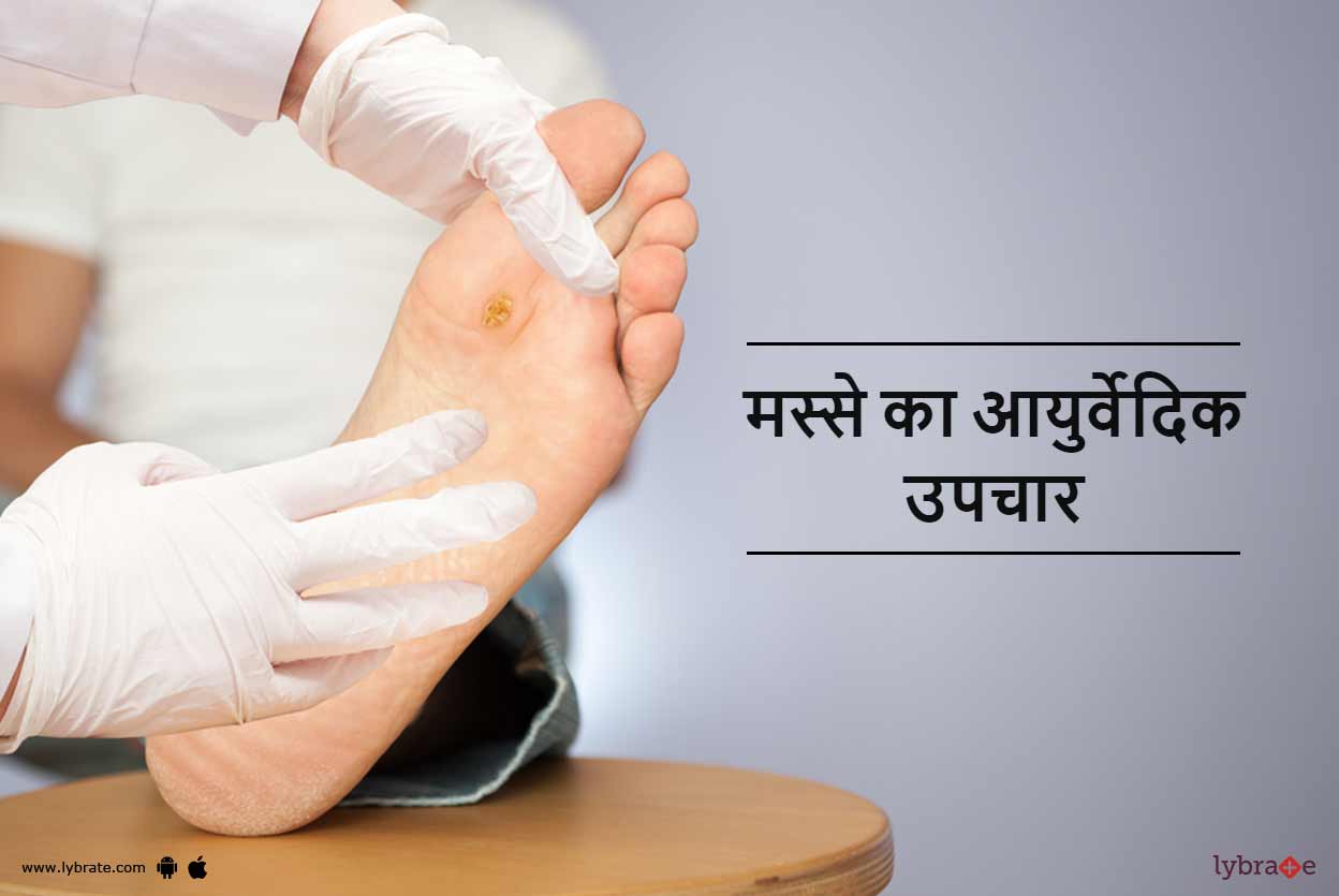 Ayurvedic Treatment Of Wart - मस्से का आयुर्वेदिक उपचार - By Dr ...