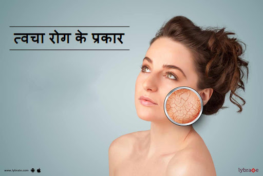 त्वचा रोग के प्रकार - Twacha Rog Ke Prakar! - By Dr. Sanjeev Kumar ...