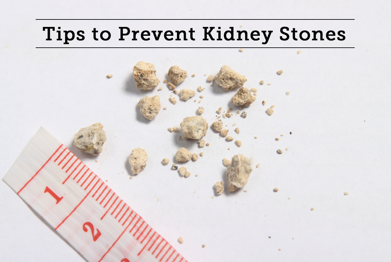 Tips to Prevent Kidney Stones - By Dr. Garima | Lybrate