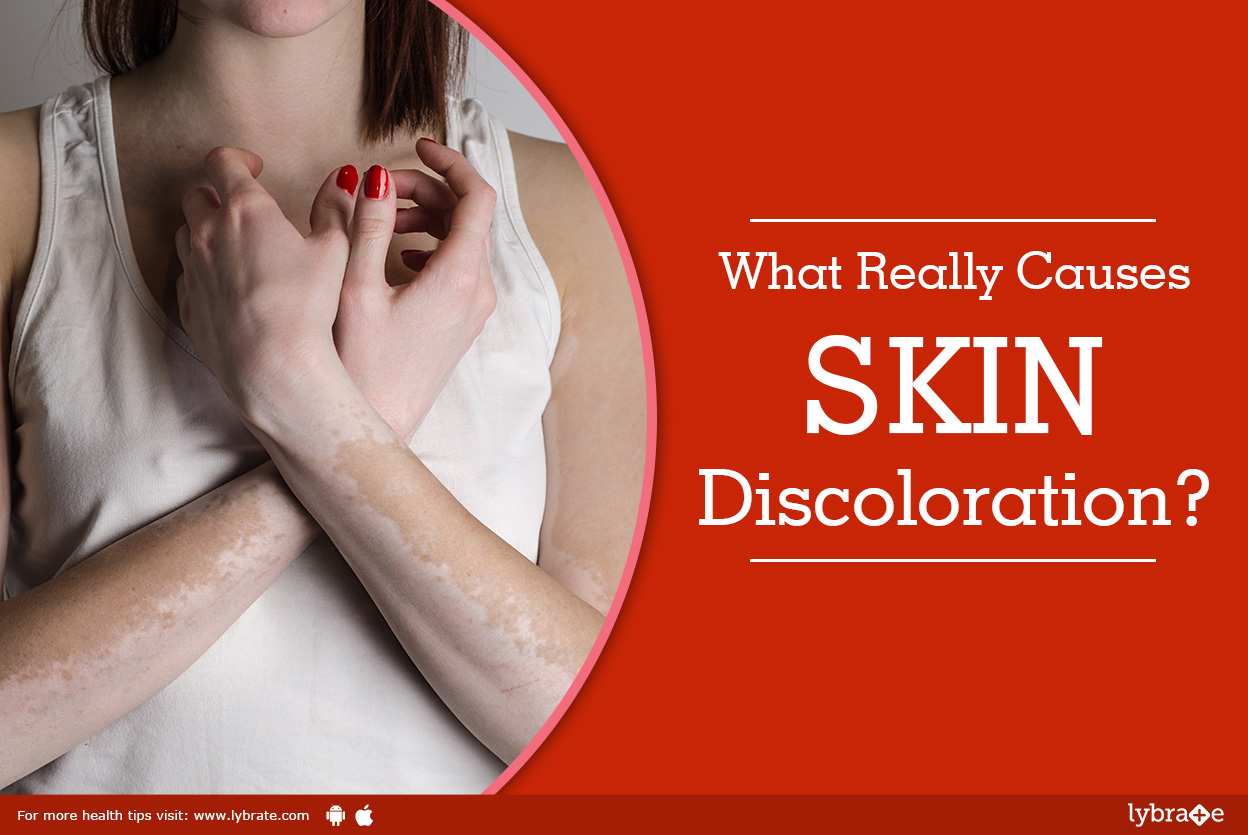 What Really Causes SKIN Discoloration? - By Dr. Abhay Talathi | Lybrate
