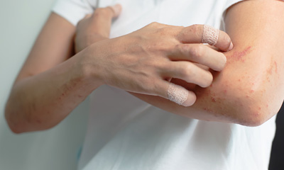 What Is An Alternative Lotion To Tinaderm Solution? Quora, 49% OFF