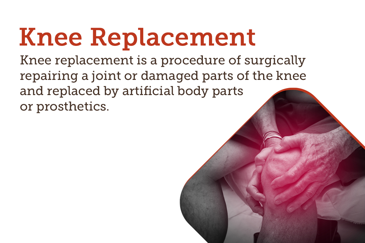 Knee Replacement: Procedure, Recovery, Cost, Risk & Complication