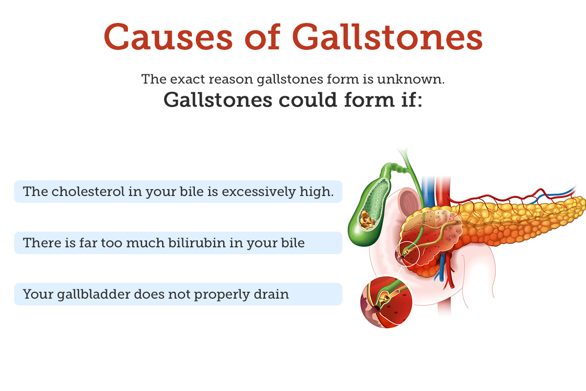 Gallstones: Treatment, Procedure, Cost, Recovery, Side Effects And More